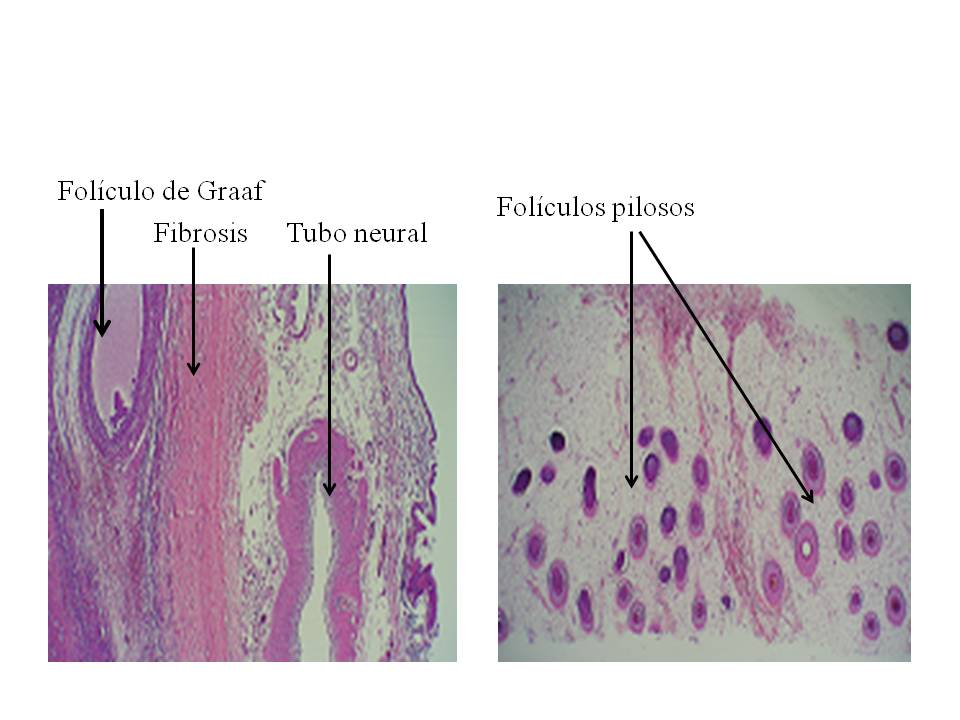 Teratoma quístico maduro (TQM) con tejido mesodérmico, endodérmico y ...