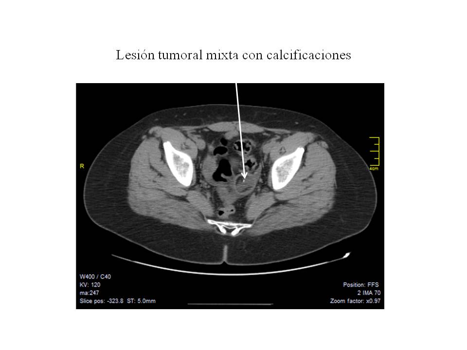 instante transmitir hipocresía tac abdomino pelvico Sustancial ...