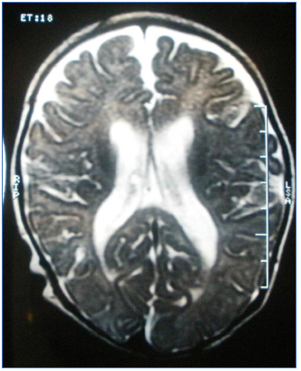 Figura 1 - Imagen de RMN cerebral