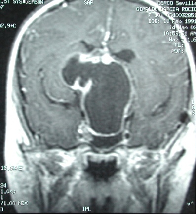 Figura 1 - Craneofaringioma con gran extensión supraselar