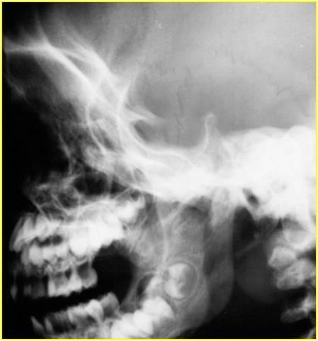 Silla turca amplia y profunda