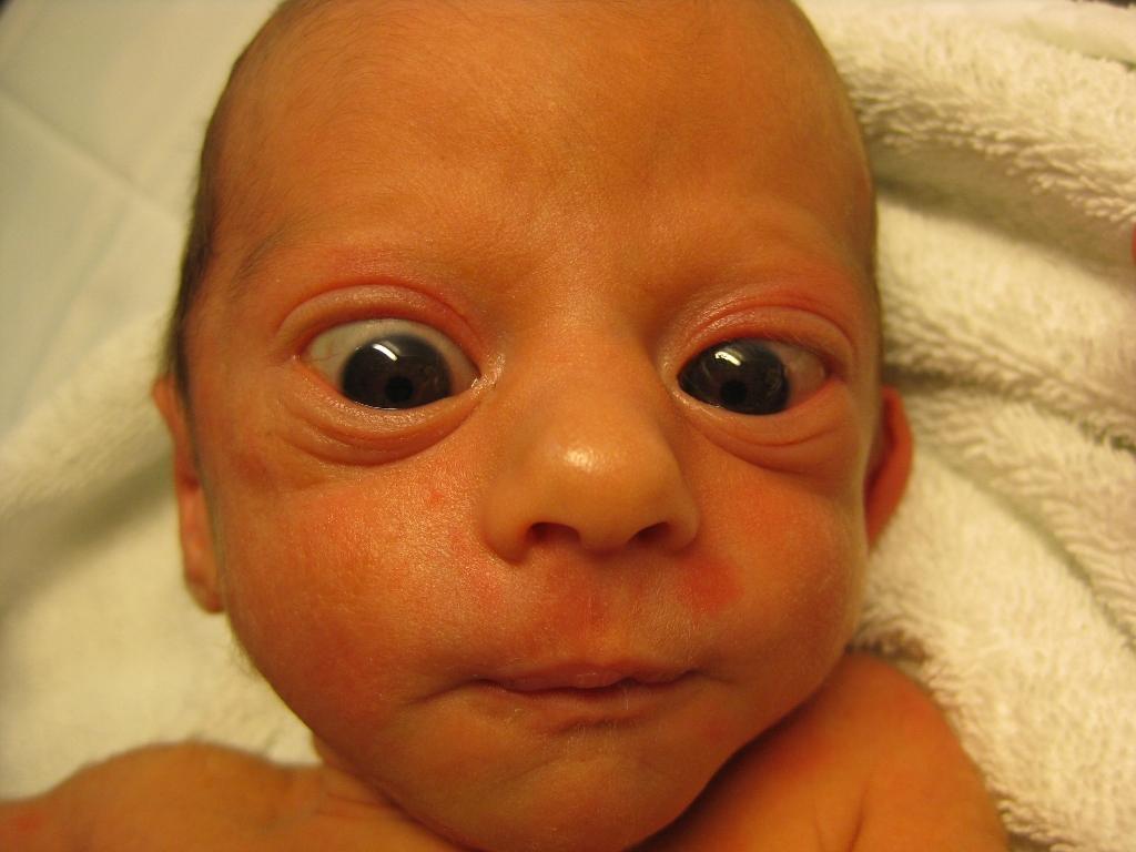 Figura 1 - Exoftalmos bilateral en las primeras 24 horas de vida