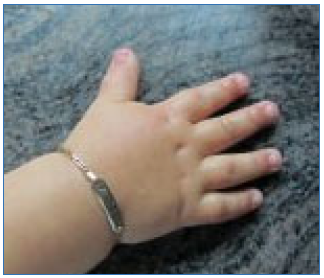 Figura 3 - Braquidactilia del quinto dedo.