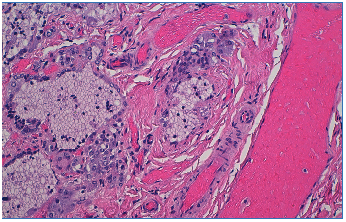 Figura 4 - Carcinoma medular tiroideo constituido por proliferación ...