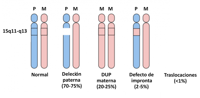 Figura 1 - Genética del síndrome de Prader Willi