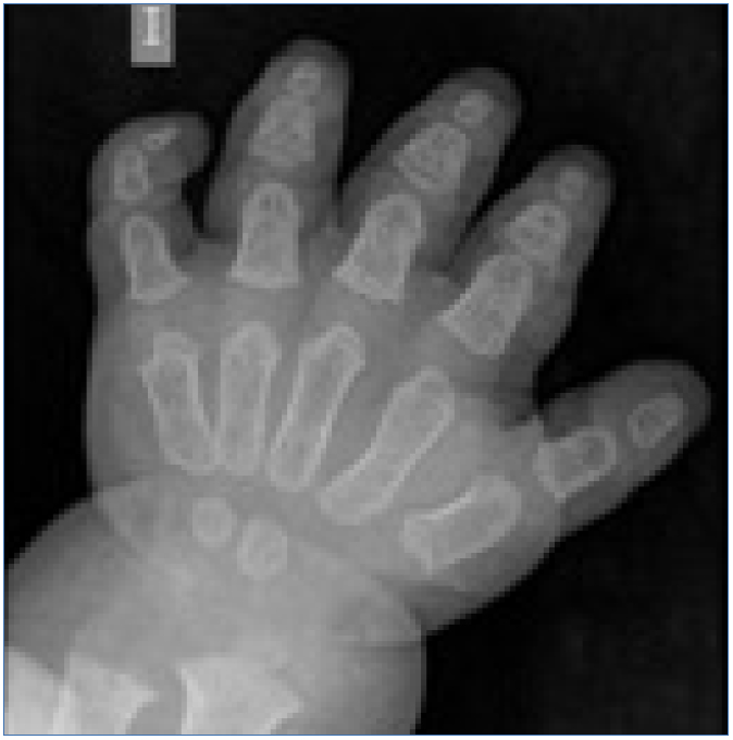 Radiografía de mano del tercer hermano a los 3 años y 9 meses de vida.