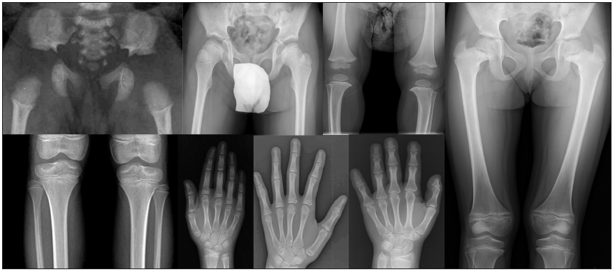 Hallazgos Radiográficos De Acondroplasia