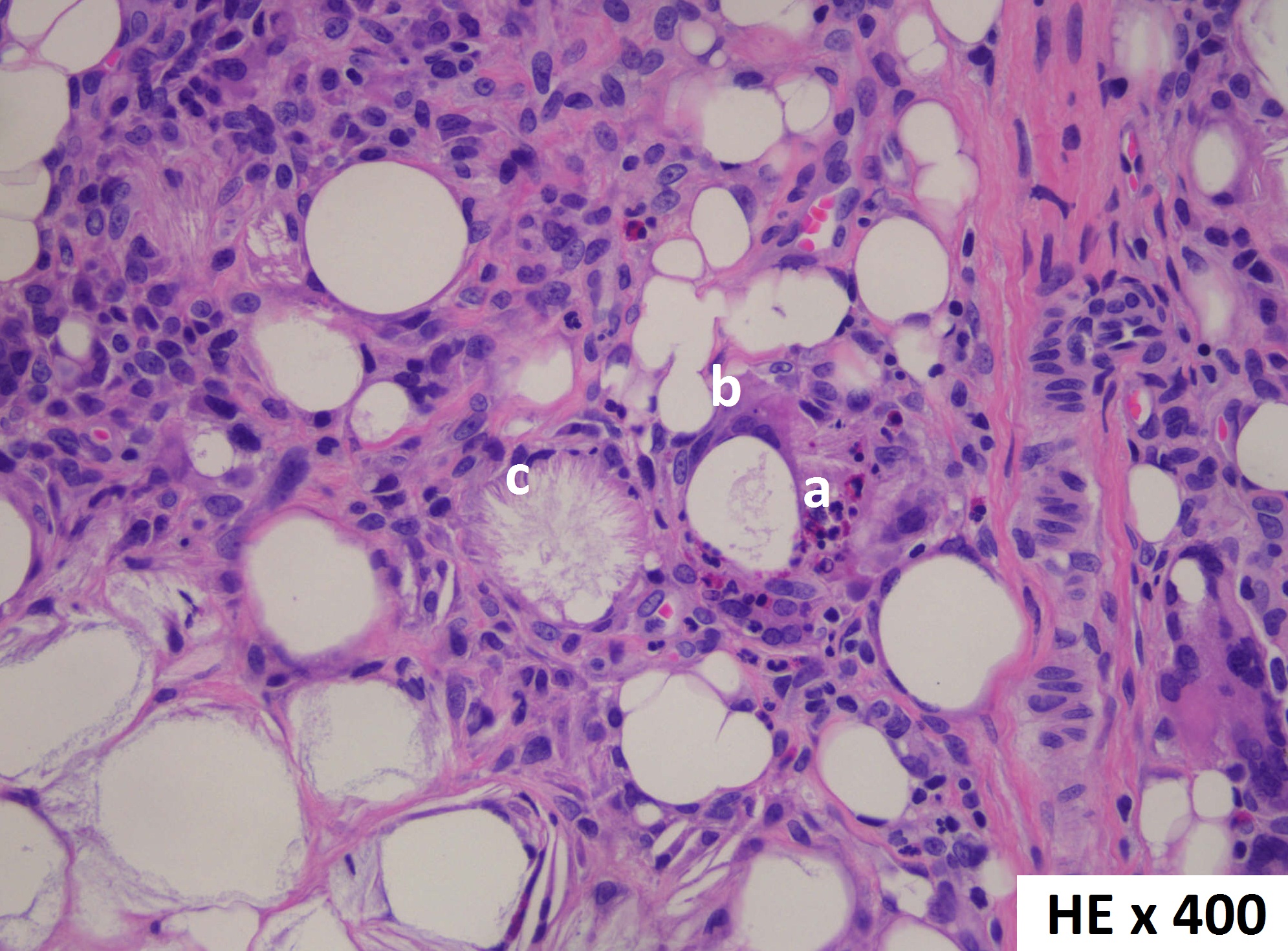 Presencia de infiltrado paraseptal histiocitario, con eosinofilos (a) y ...