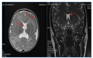 Figura 1 - RNM cerebral T2